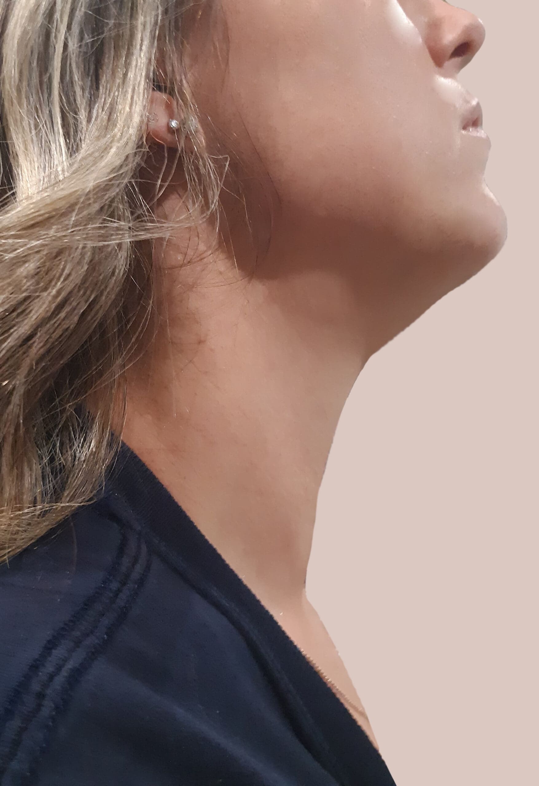 Thyroid Ablation | Thyroid RFA | STARmed America